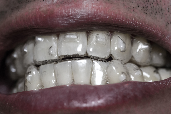 Invisalign, Tampa, FL | Invisalign in Tampa, Florida